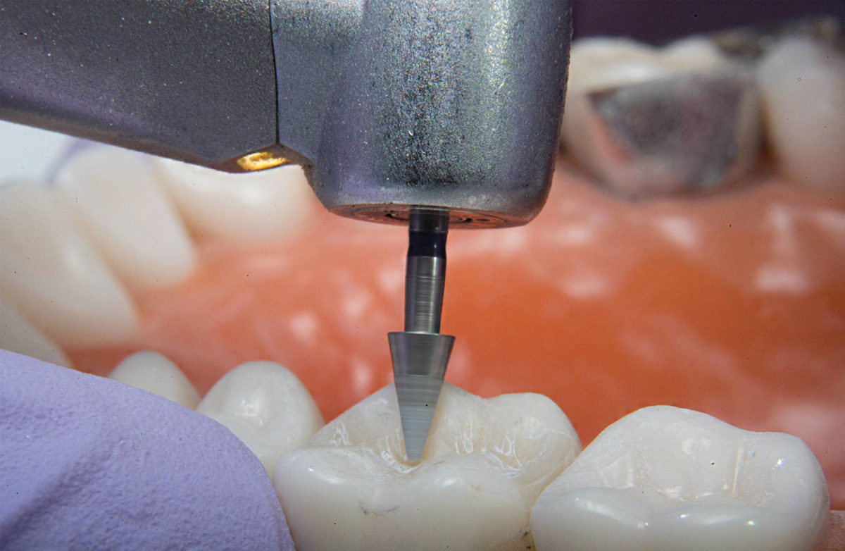 PR261 - Occlusinator® Bur 6/PK - Strauss Diamond