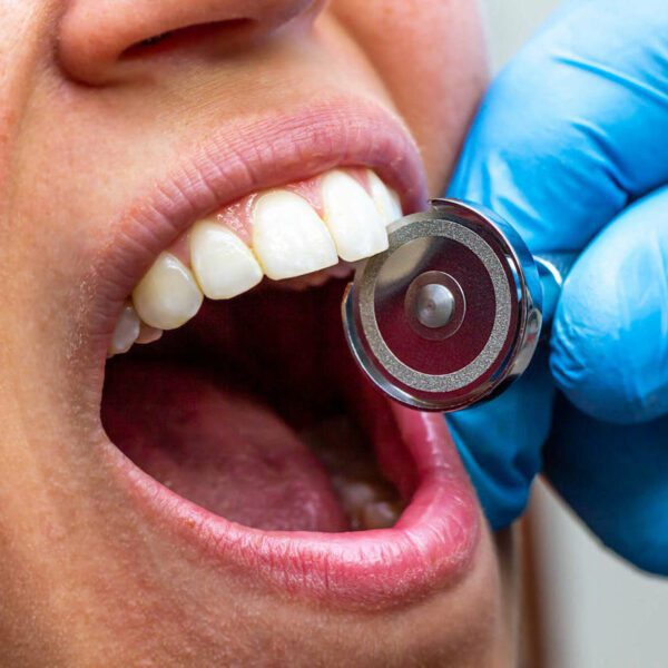 IPR Discs - Interproximal Spacing Instruments - Strauss Diamond